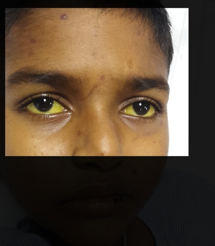 Wilsons Disease Skin