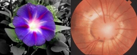 Morning Glory Optic Disc