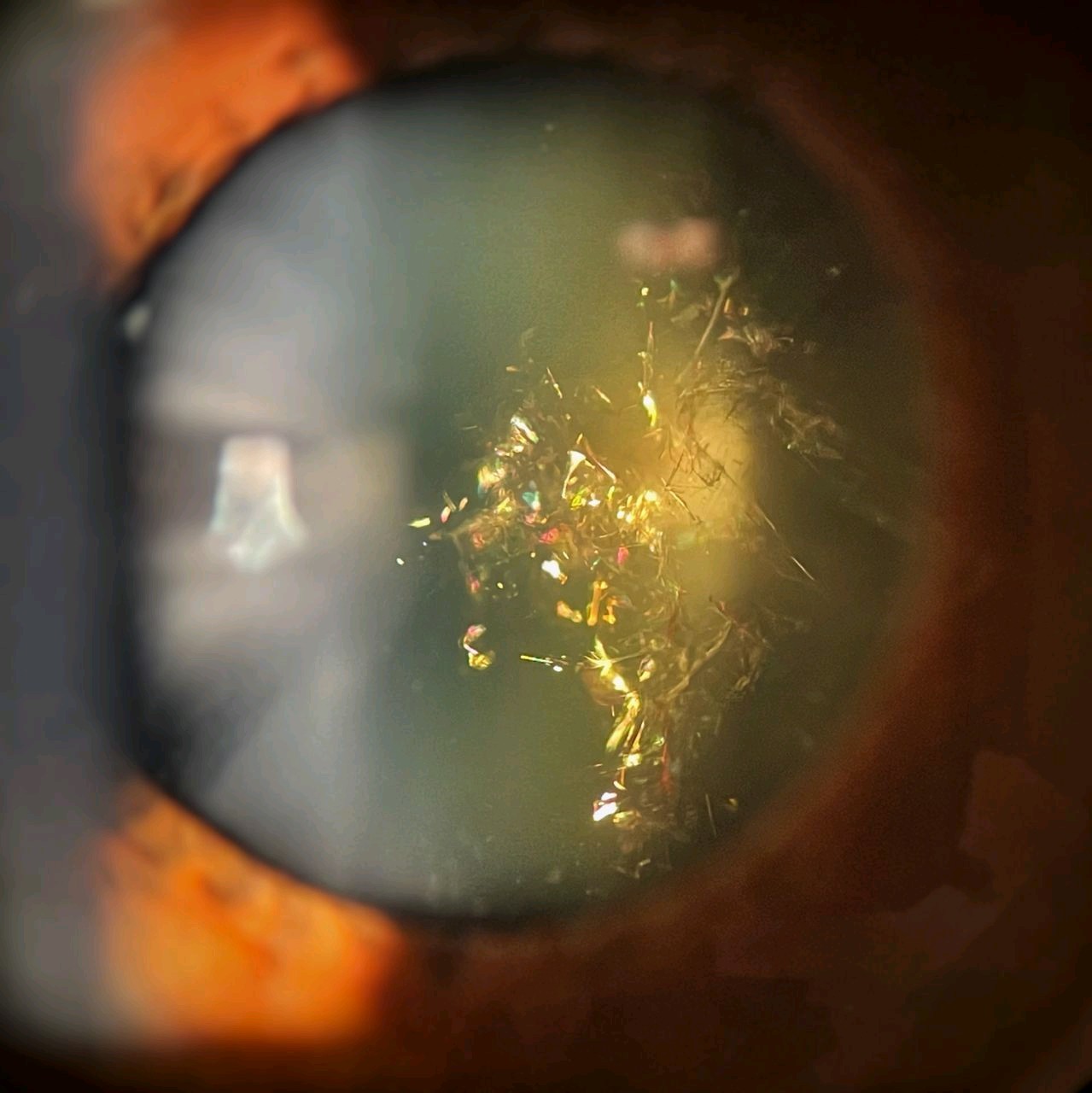 Christmas Tree Cataract