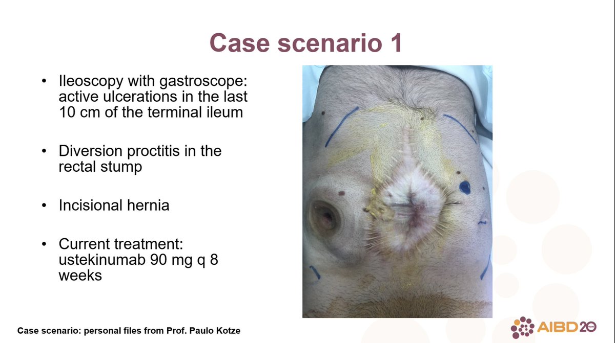 Management of STOMA complications #AIBD2021 @IBDConference #GITwitter # ...
