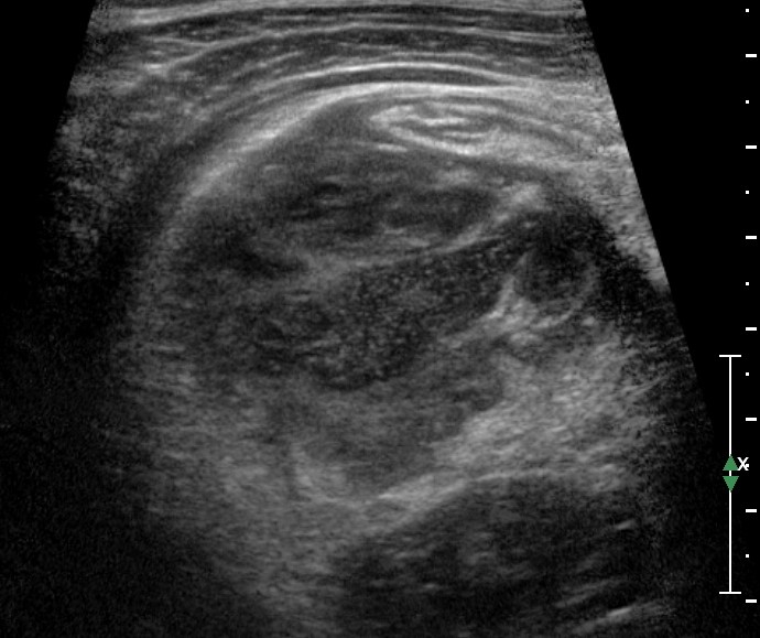 Los abscesos abdominales hace tiempo que son enfermedades de manejo ...