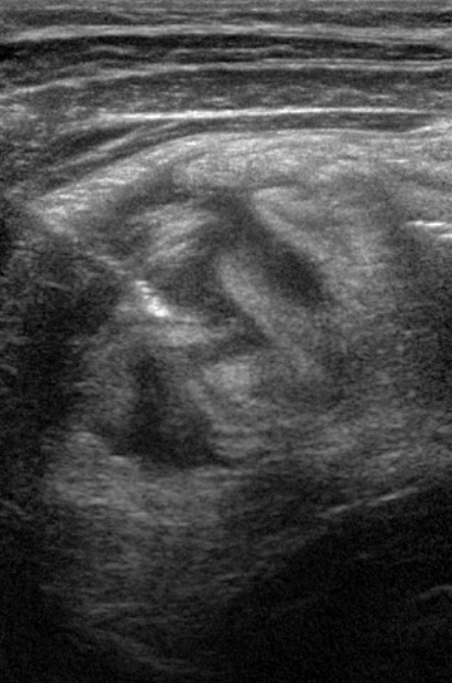 Los abscesos abdominales hace tiempo que son enfermedades de manejo ...