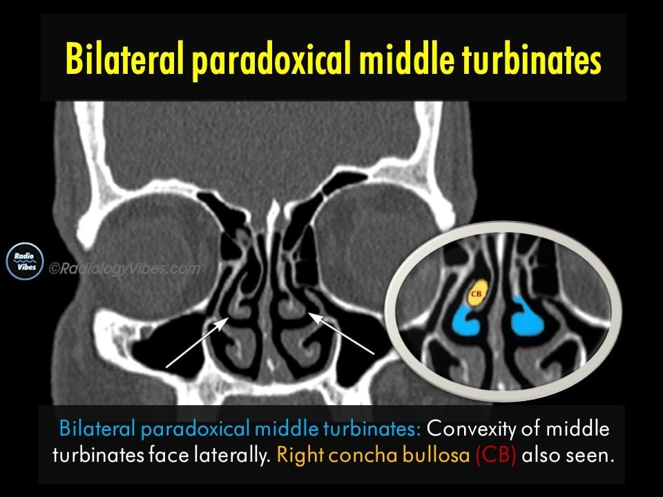 Nasal Turbinates Xray