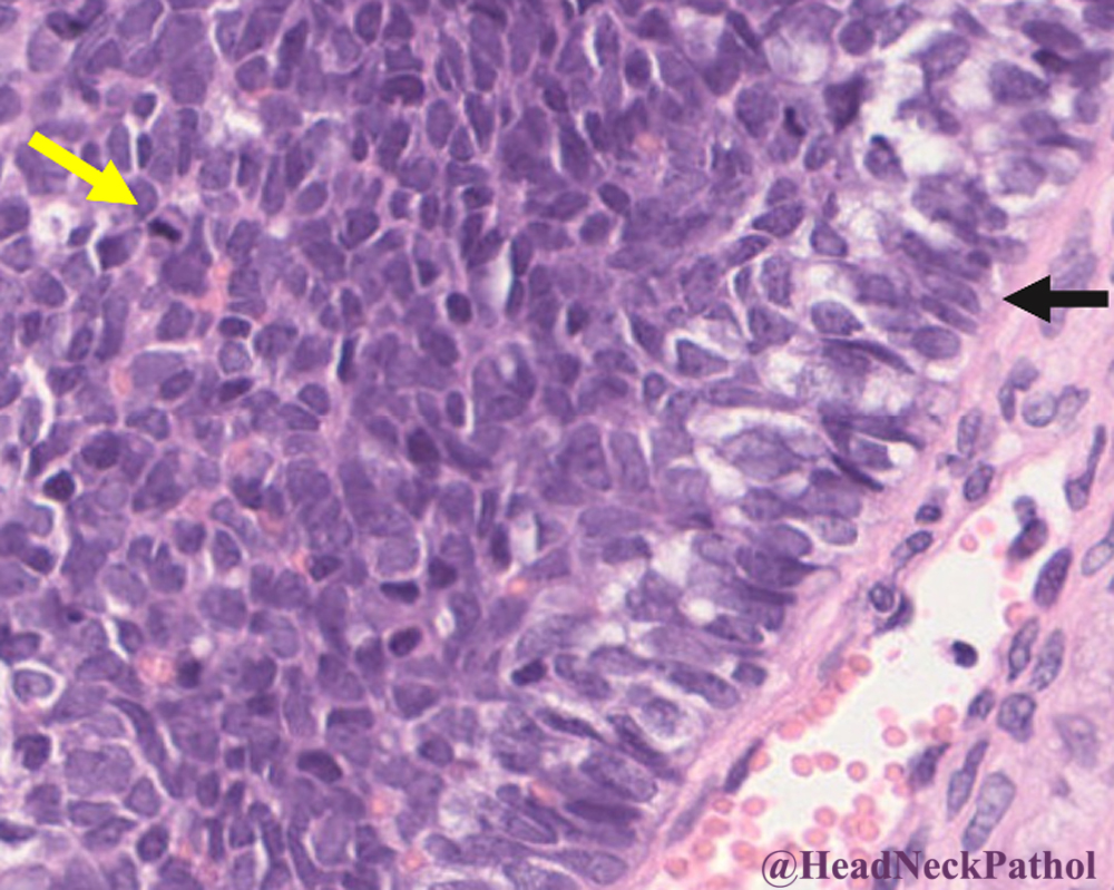 Ewing Sarcoma Histology Undifferentiated Pleomorphic Sarcoma