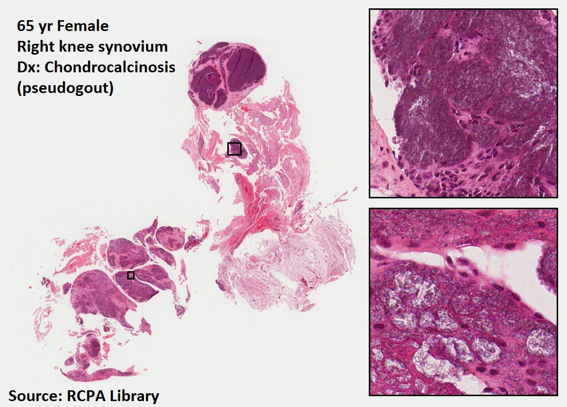 Chondrocalcinosis Histology