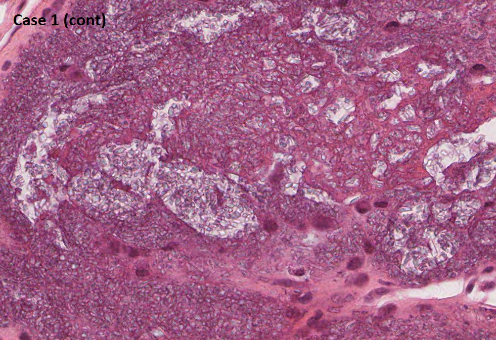 Chondrocalcinosis Histology