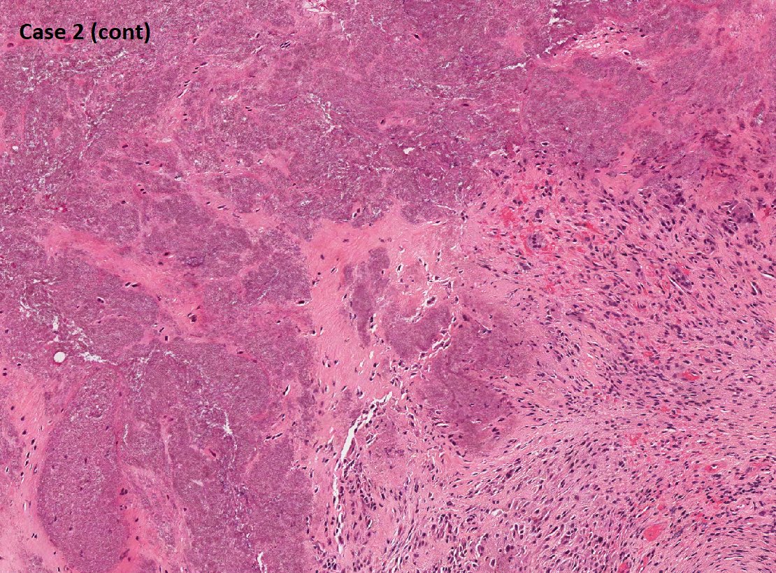 Chondrocalcinosis Histology