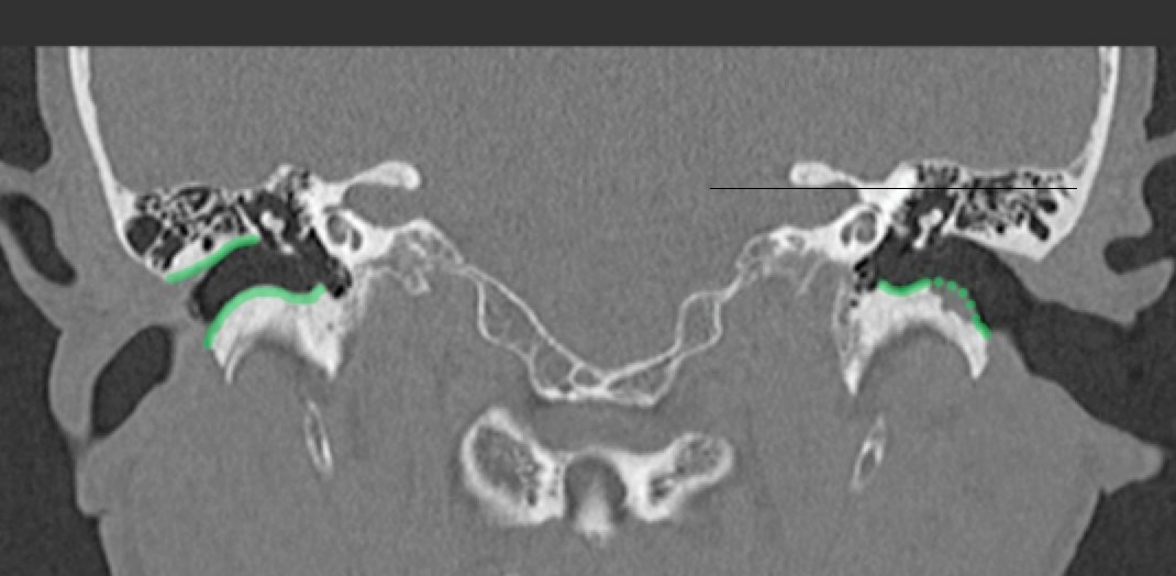Scutum Temporal Bone