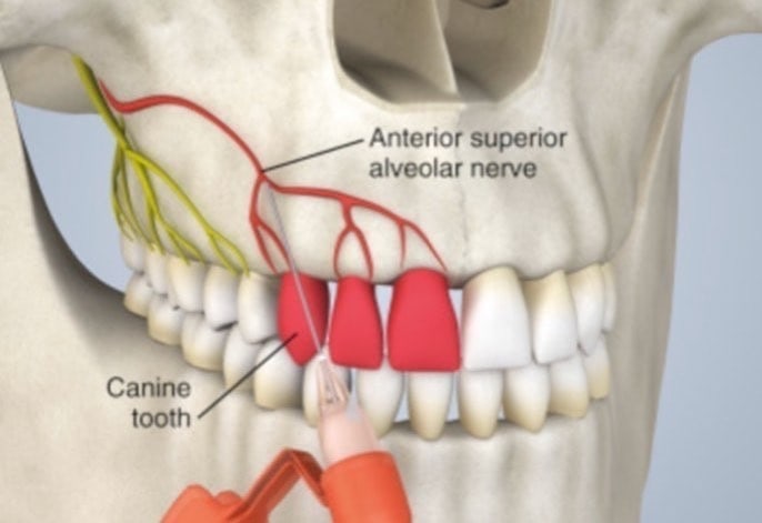Anterior Superior Alveolar Nerve Block