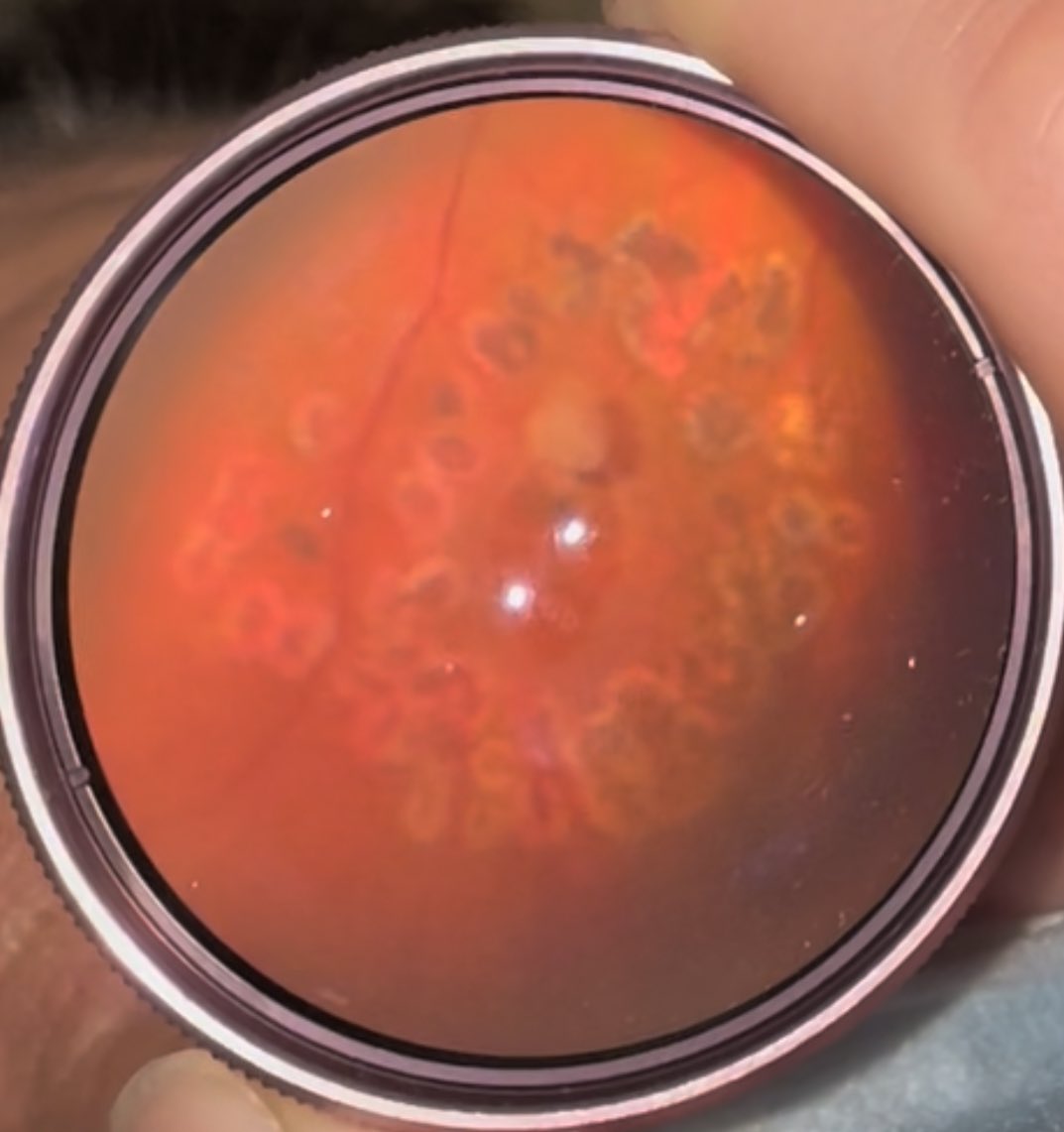 Operculated Retinal Hole