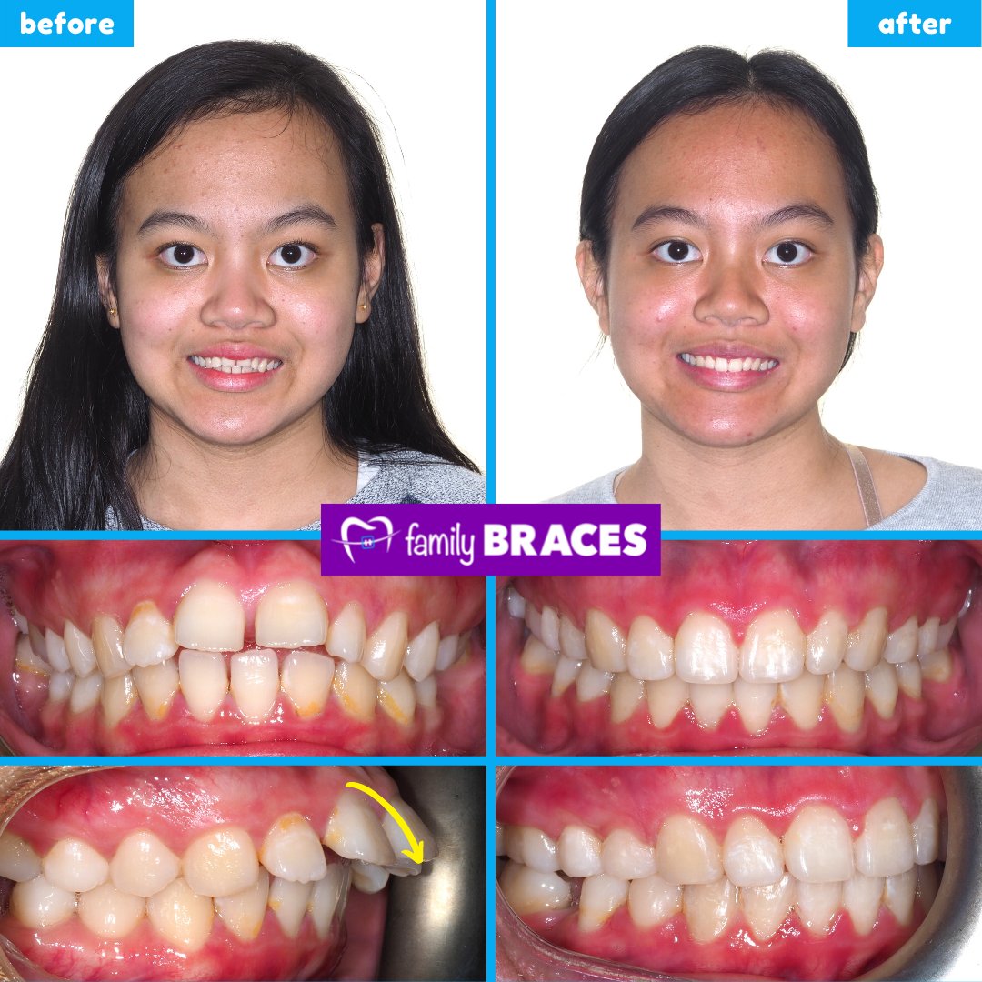 Overbite Smile Overbite Or Deep Bite Treatment | Waverley Orthodontics