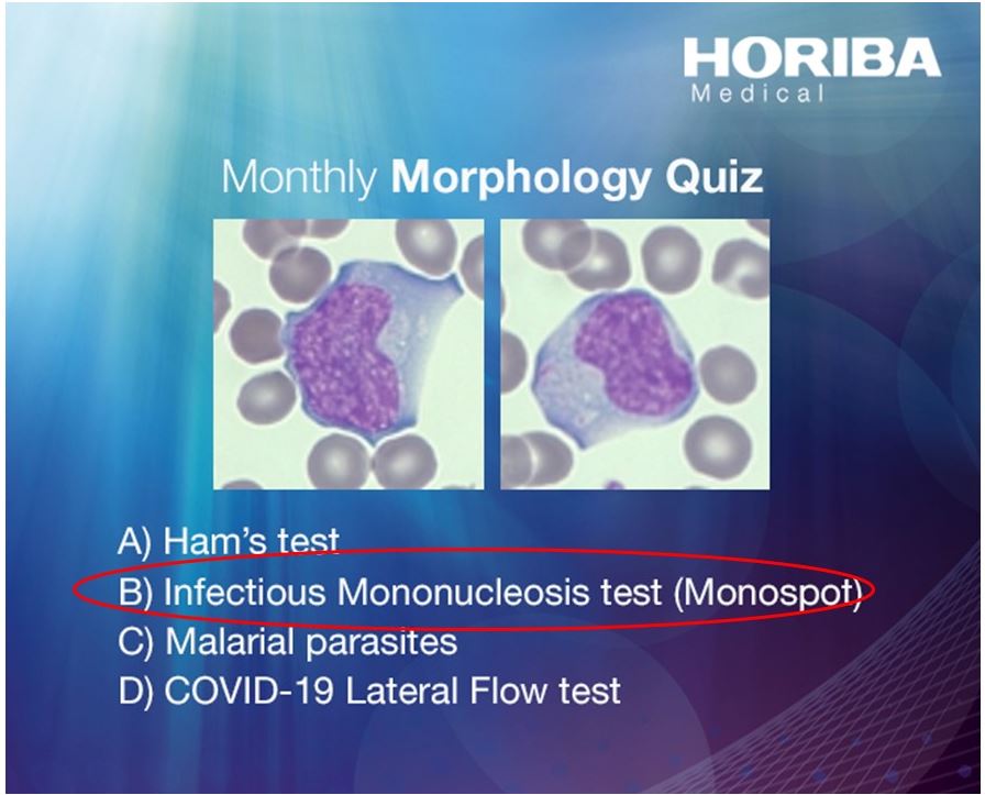 Infectious Mononucleosis Cells