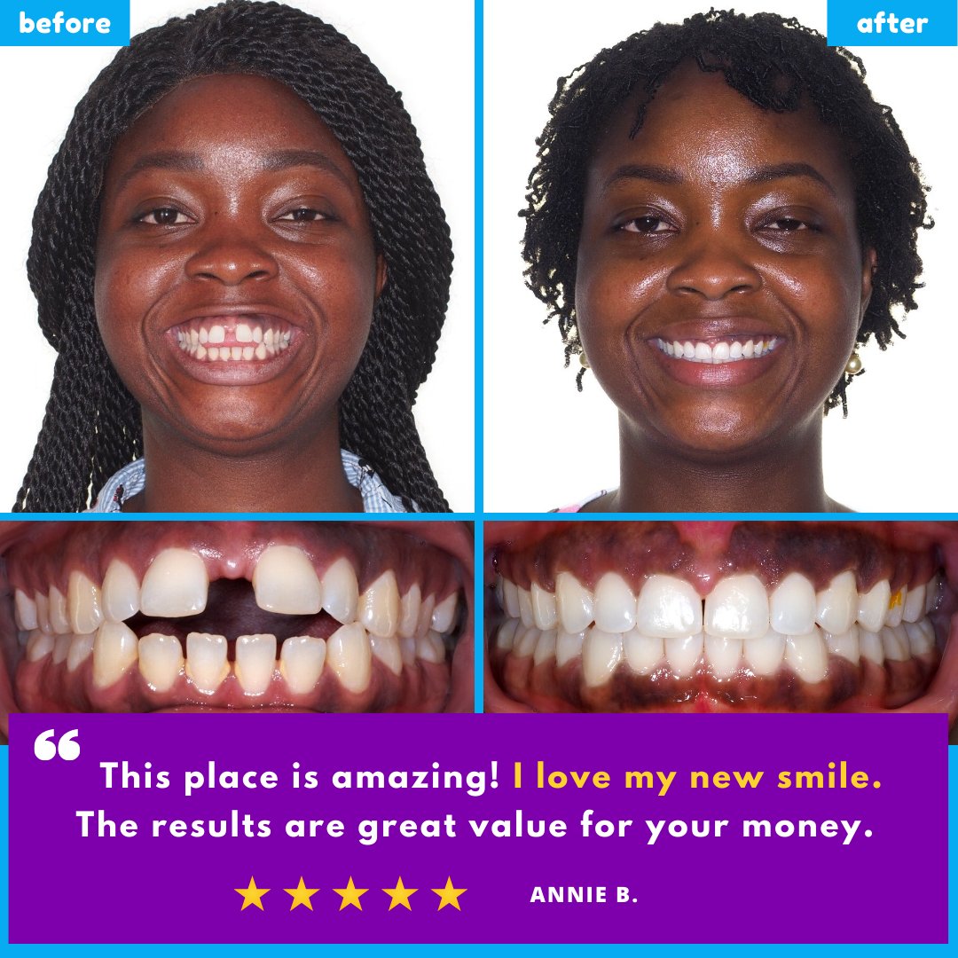 Invisalign Before And After Spacing