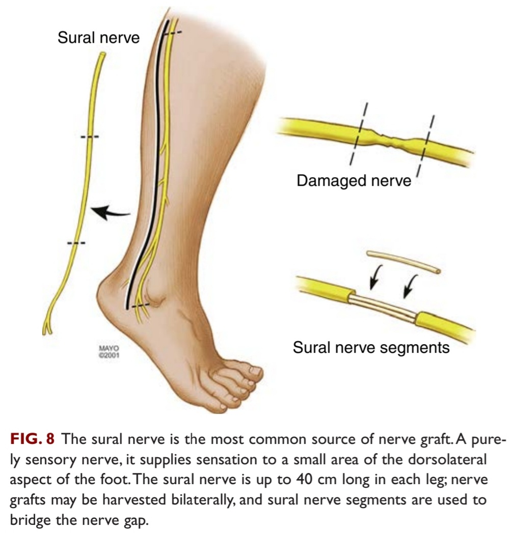 Sural Nerve Graft
