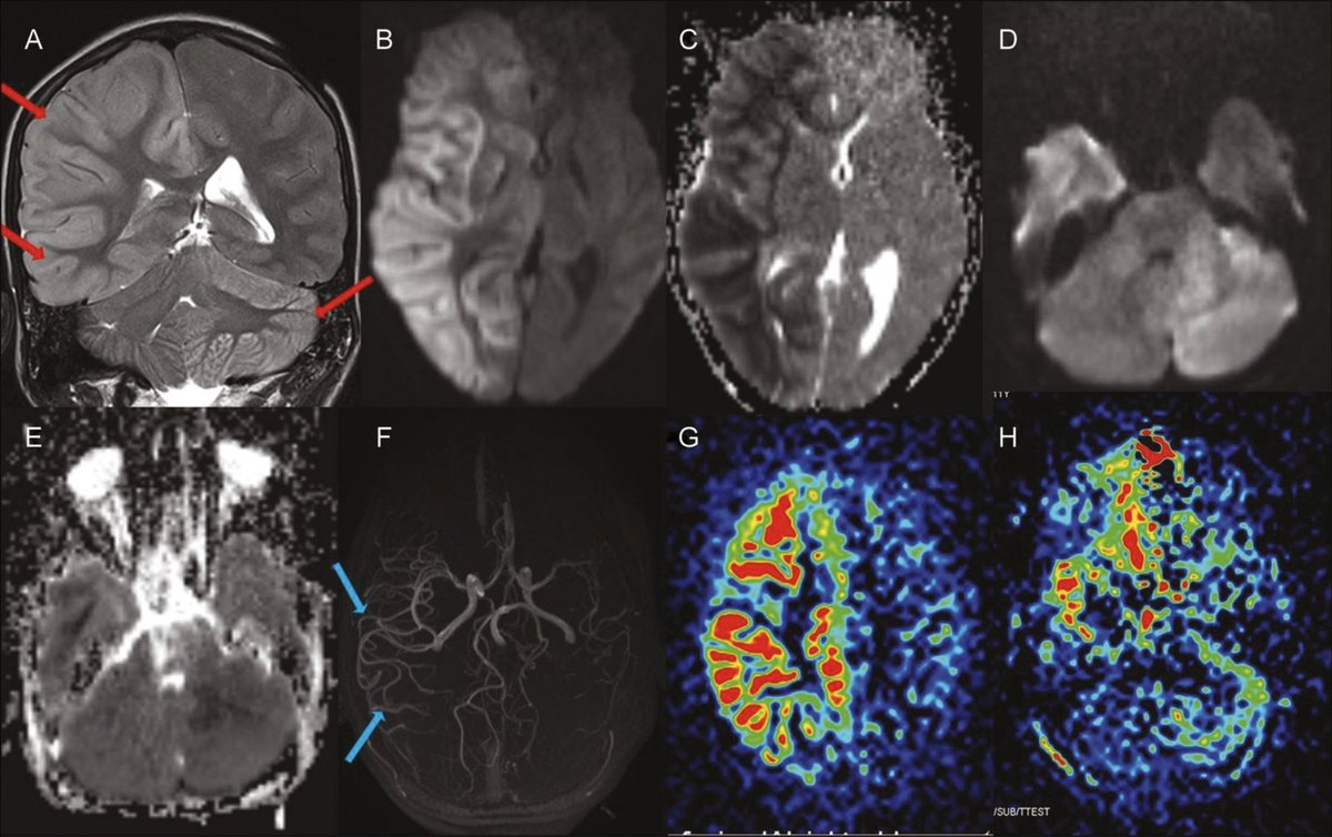 Can Cerebellum be affected in seizures?? Can cerebellar perfusion ...