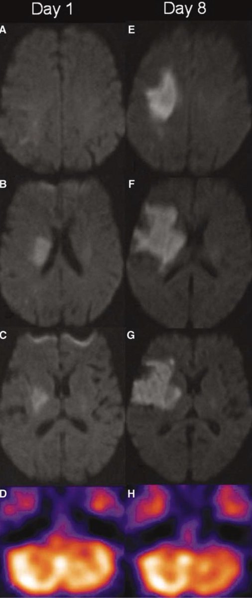 Can Cerebellum be affected in seizures?? Can cerebellar perfusion ...