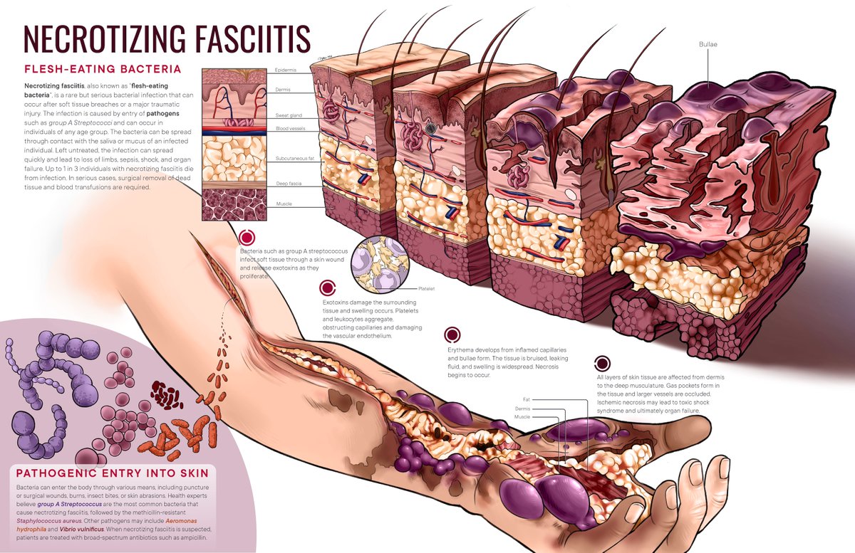 Necrotizing Fasciitis Diagram Necrotizing Fasciitis: Pathogenesis And