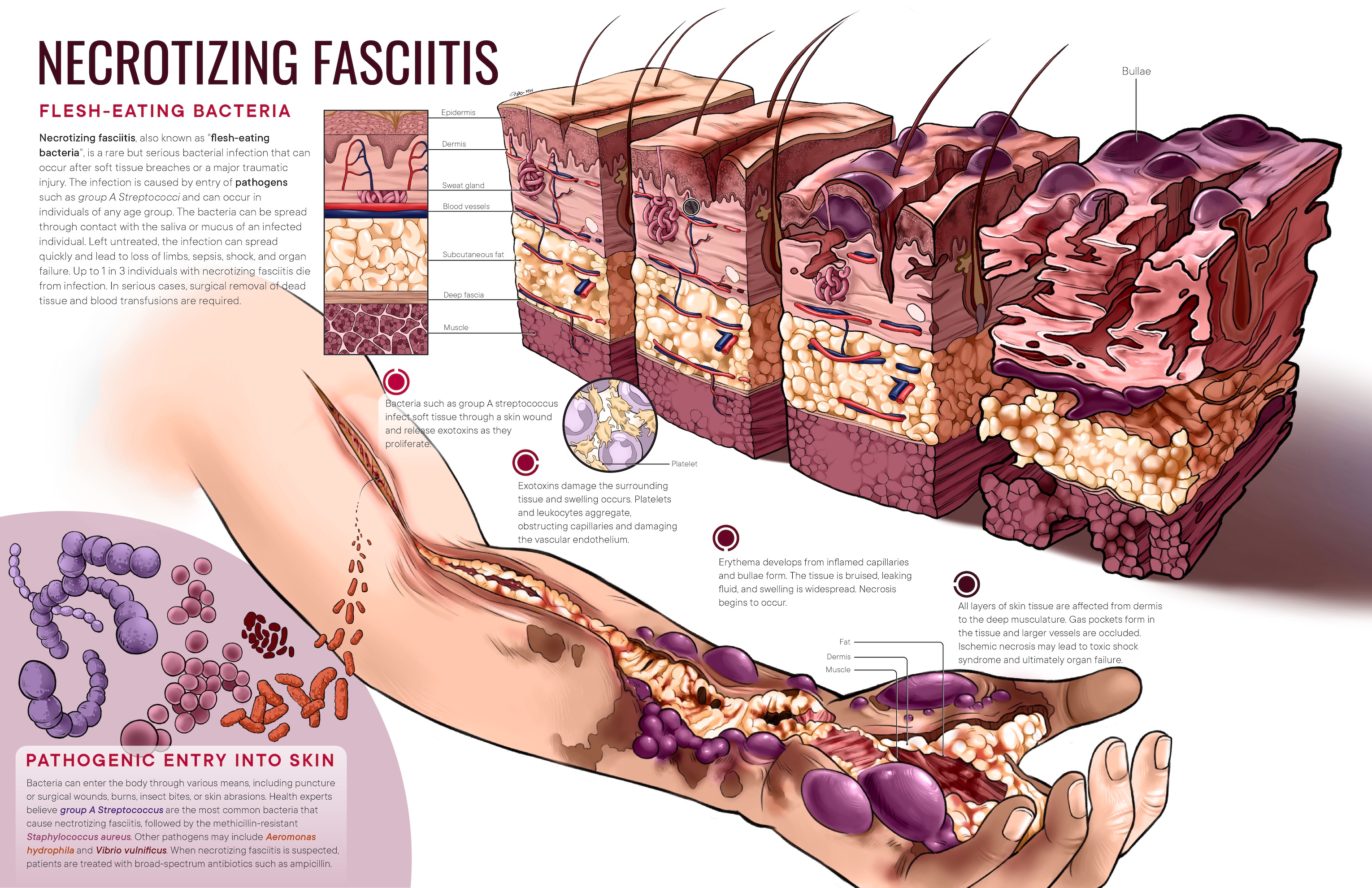 Necrotizing Fasciitis Bacteria Structure