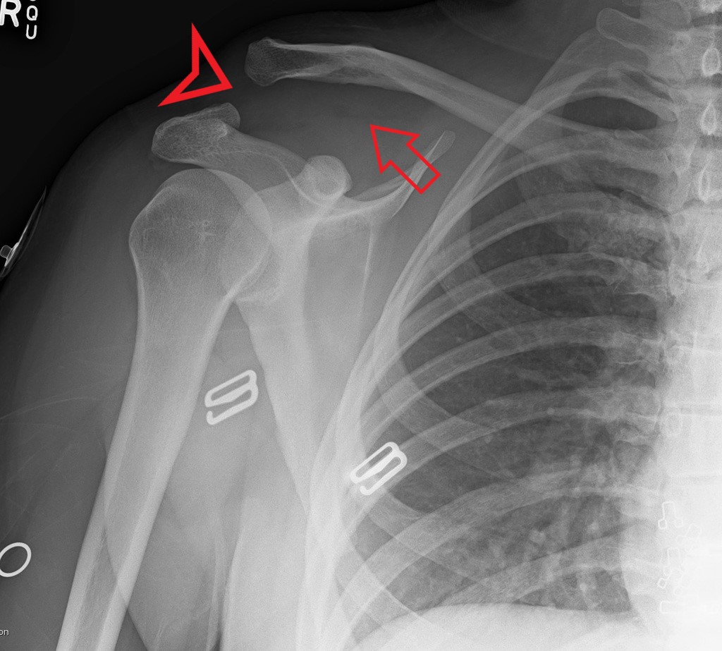 Acromioclavicular Joint X Ray