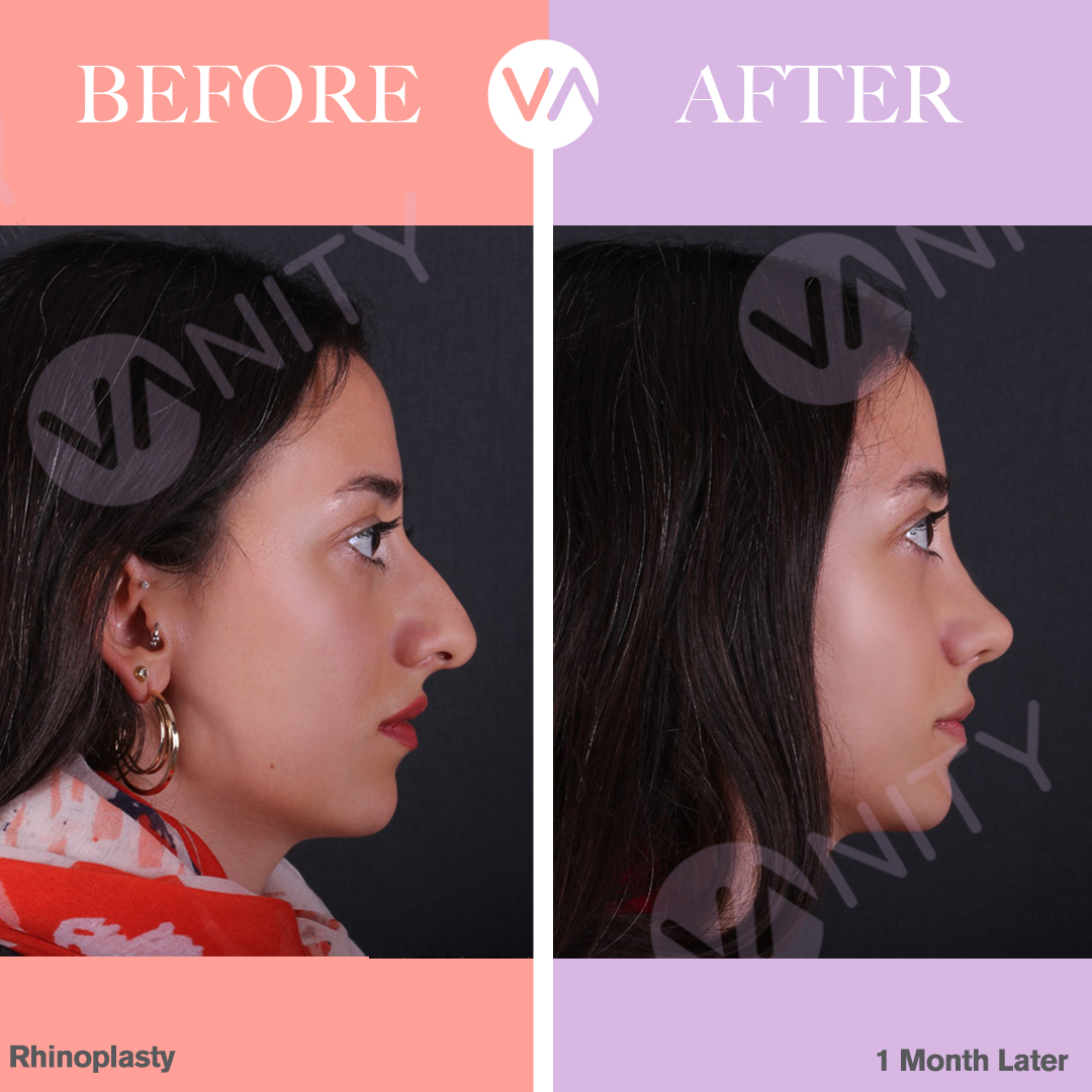 Most Beautiful Nose Shape