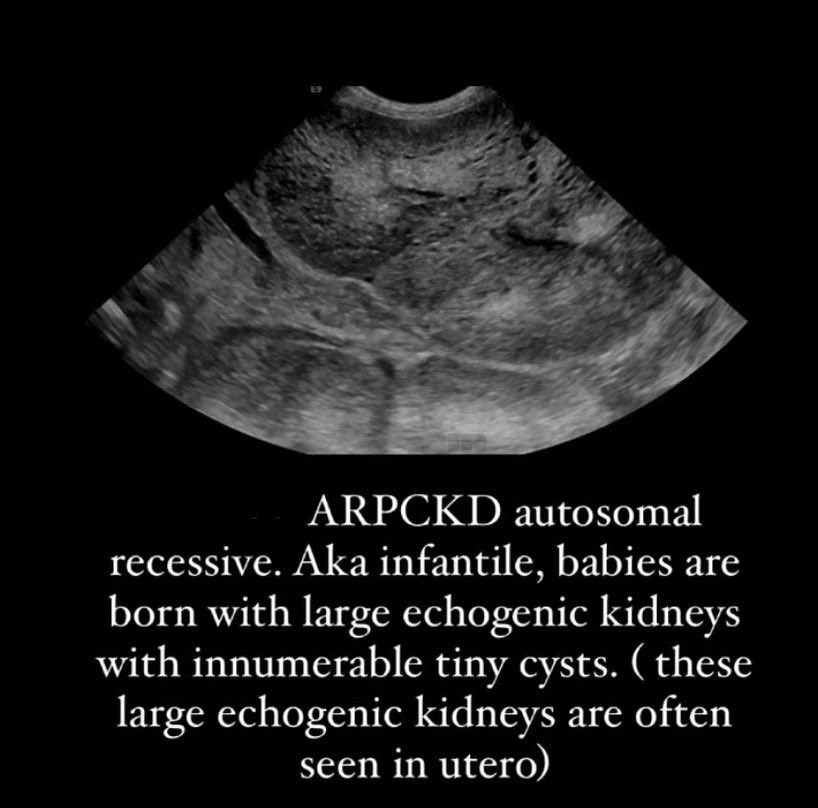Infantile Polycystic Kidney Disease Ultrasound