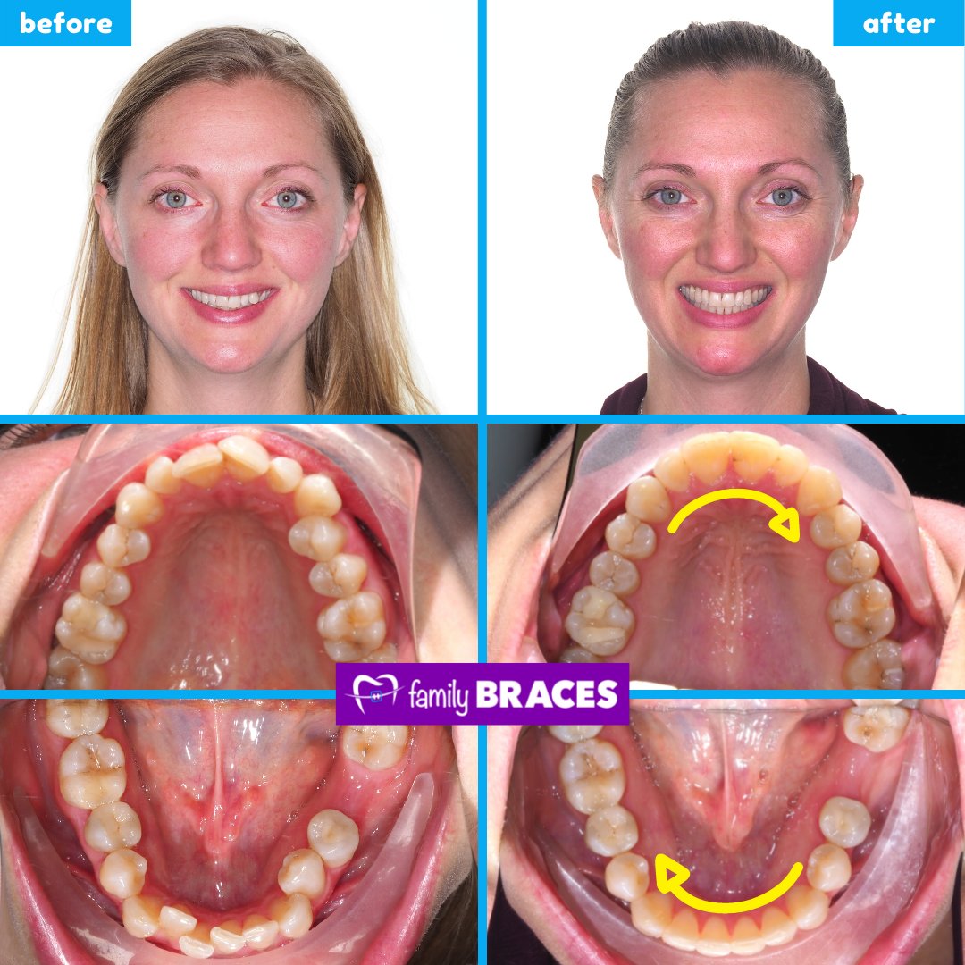 Overlapping Front Teeth Inman Aligner | Hopewell Junction, NY | Edward