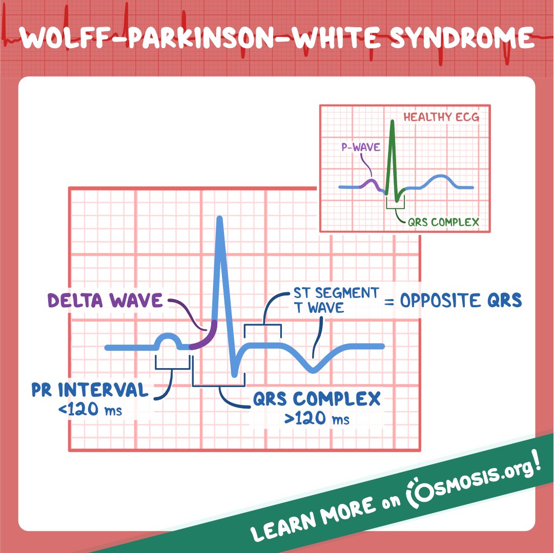 Wolff Parkinson White Syndrome