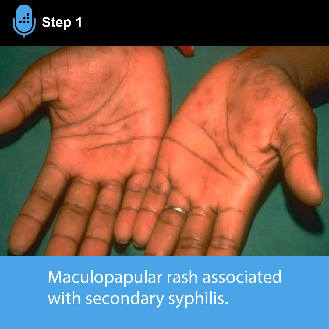 Syphilis Maculopapular Rash