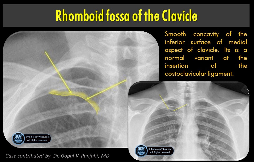 Clavicle Anatomy Xray