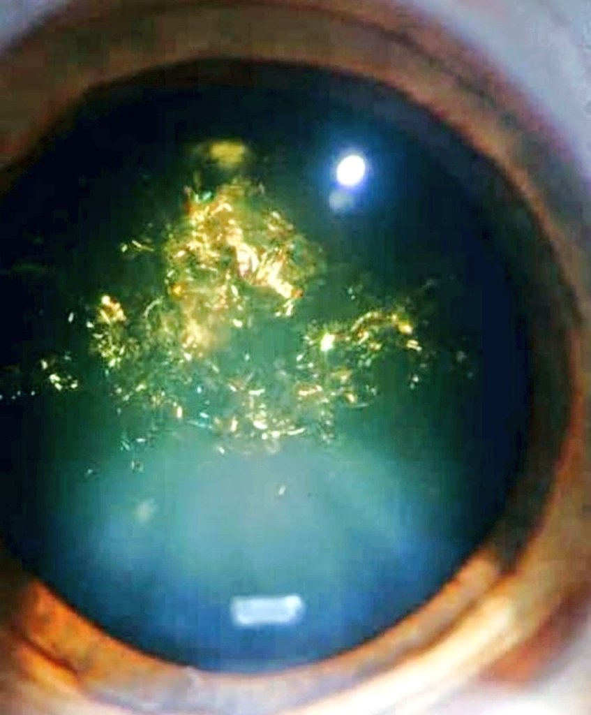 Christmas Tree Cataract Myotonic Dystrophy