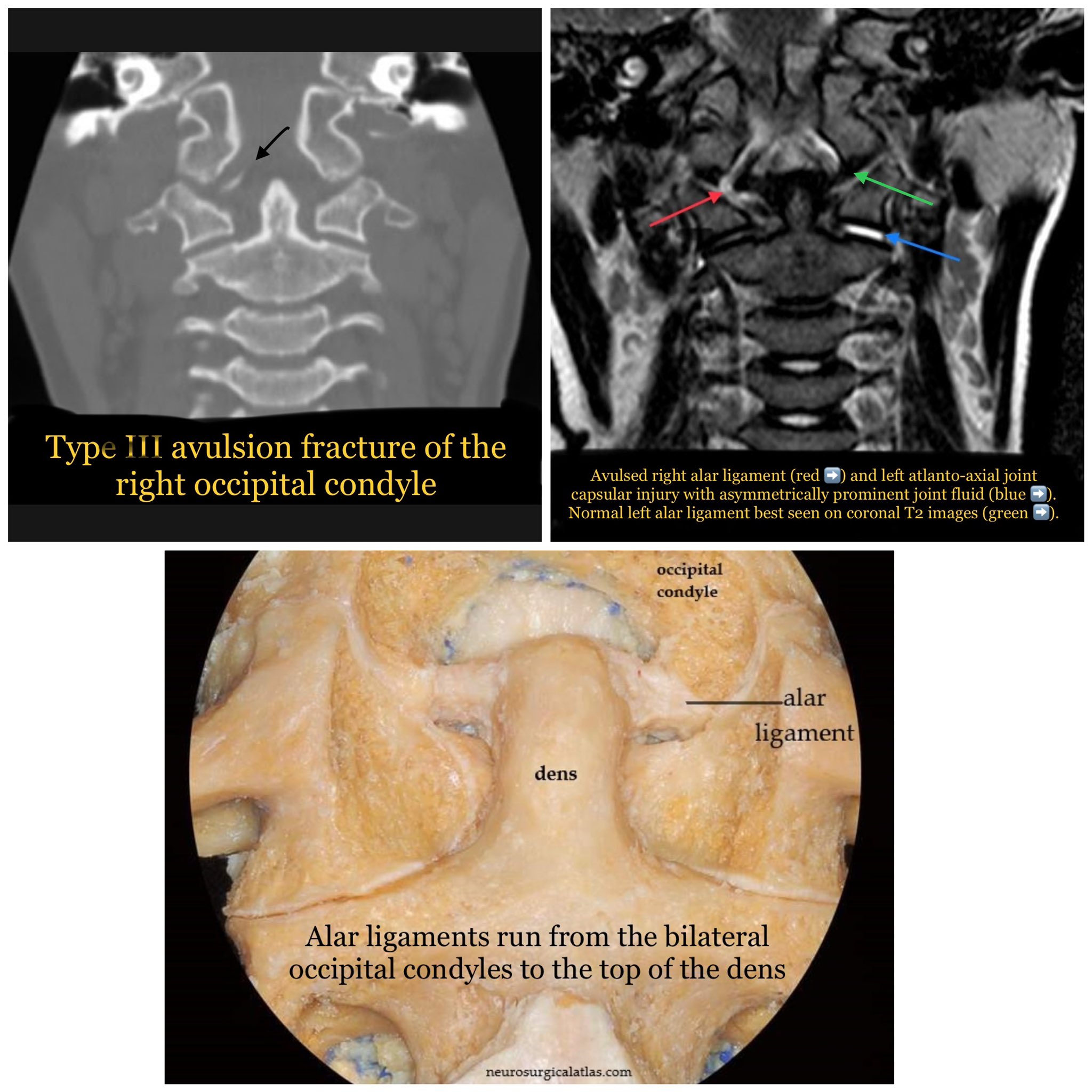 Occipital Condyle Anatomy