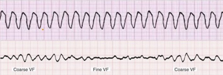 Coarse Ventricular Tachycardia