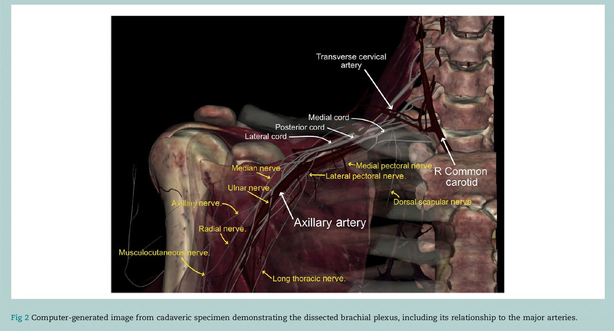 Transverse Cervical Artery Cadaver