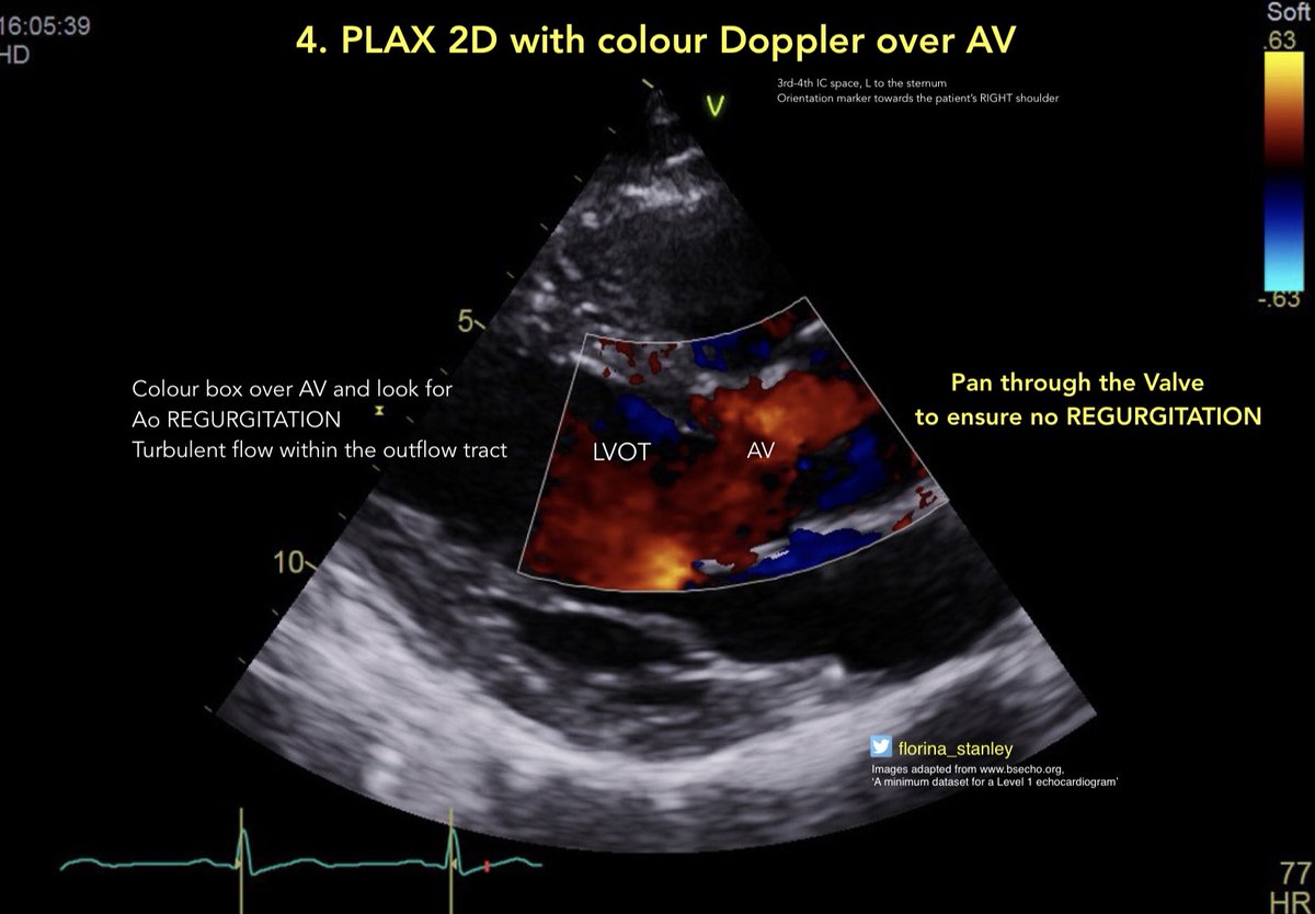 1/18 annotated @bsecho Minimum DataSet images for Level 1 BSE Echo ...