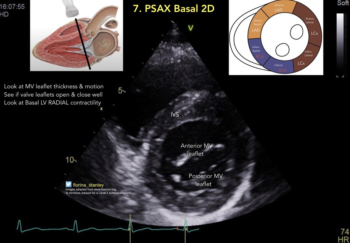 1/18 annotated @bsecho Minimum DataSet images for Level 1 BSE Echo ...