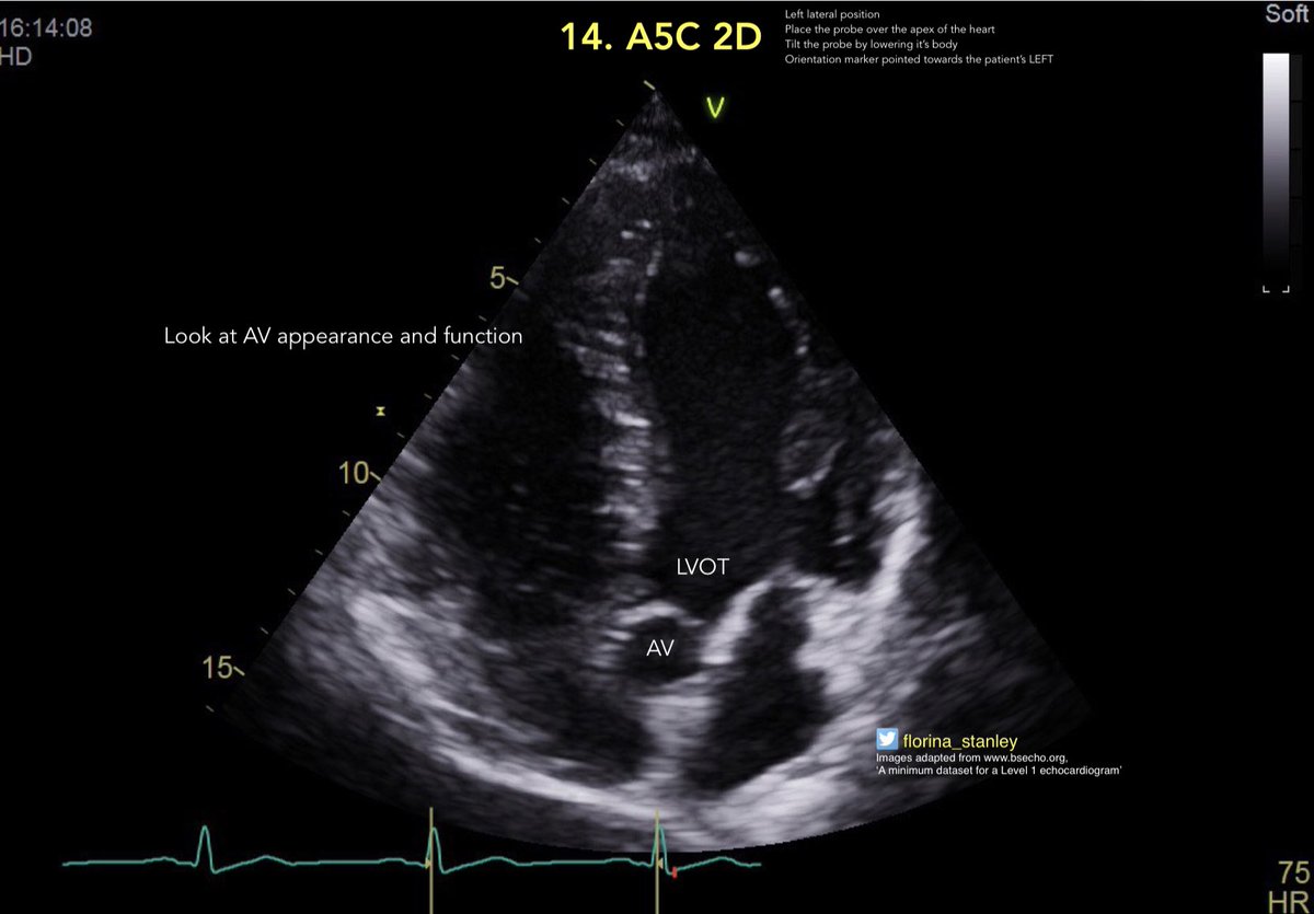 1/18 annotated @bsecho Minimum DataSet images for Level 1 BSE Echo ...