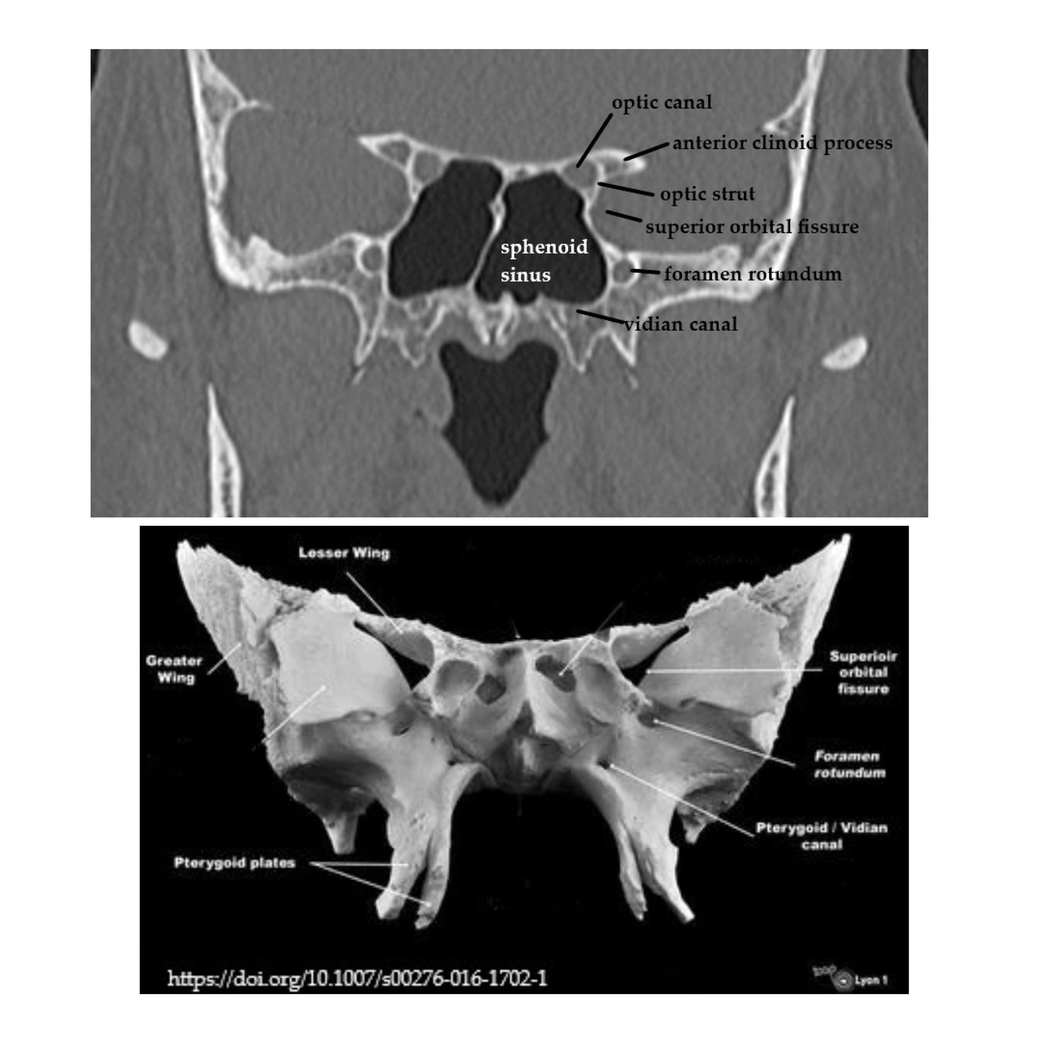 Superior Orbital Fissure Sphenoid