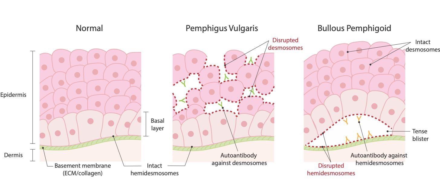 Bullous Pemphigoid Pictures
