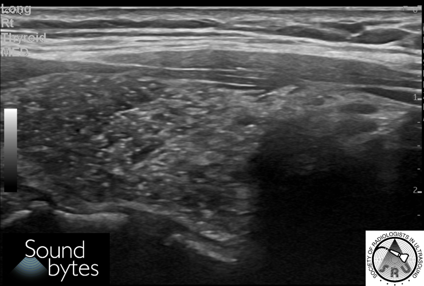 Papillary Thyroid Cancer Ultrasound