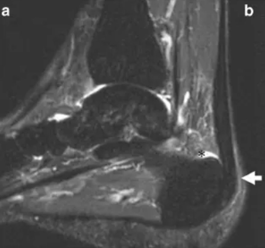 Retrocalcaneal Bursitis Mri