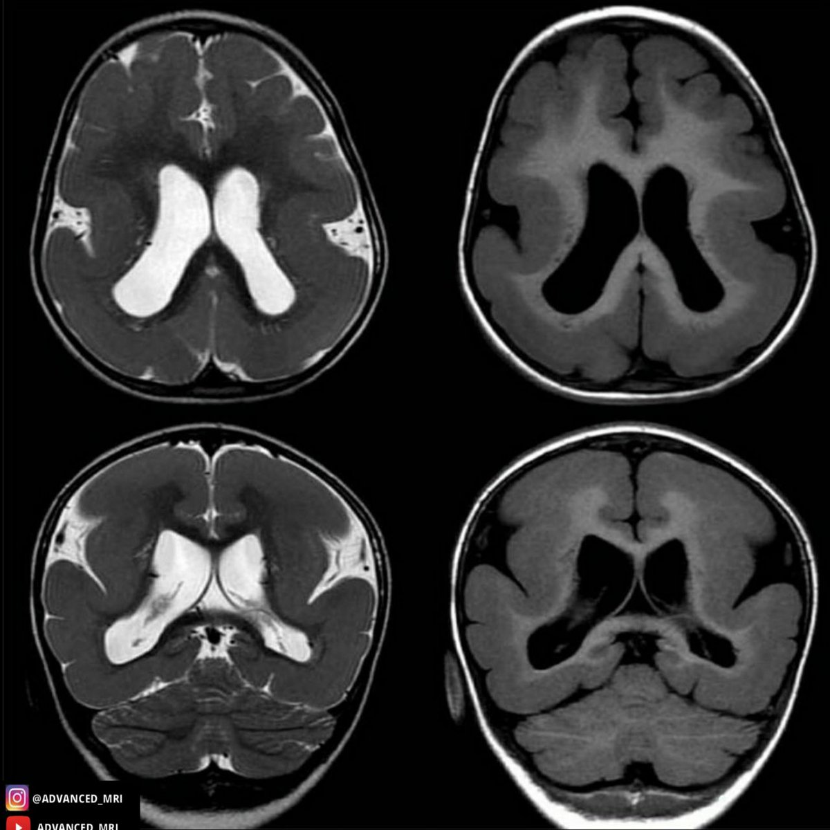Lissencephaly Mri