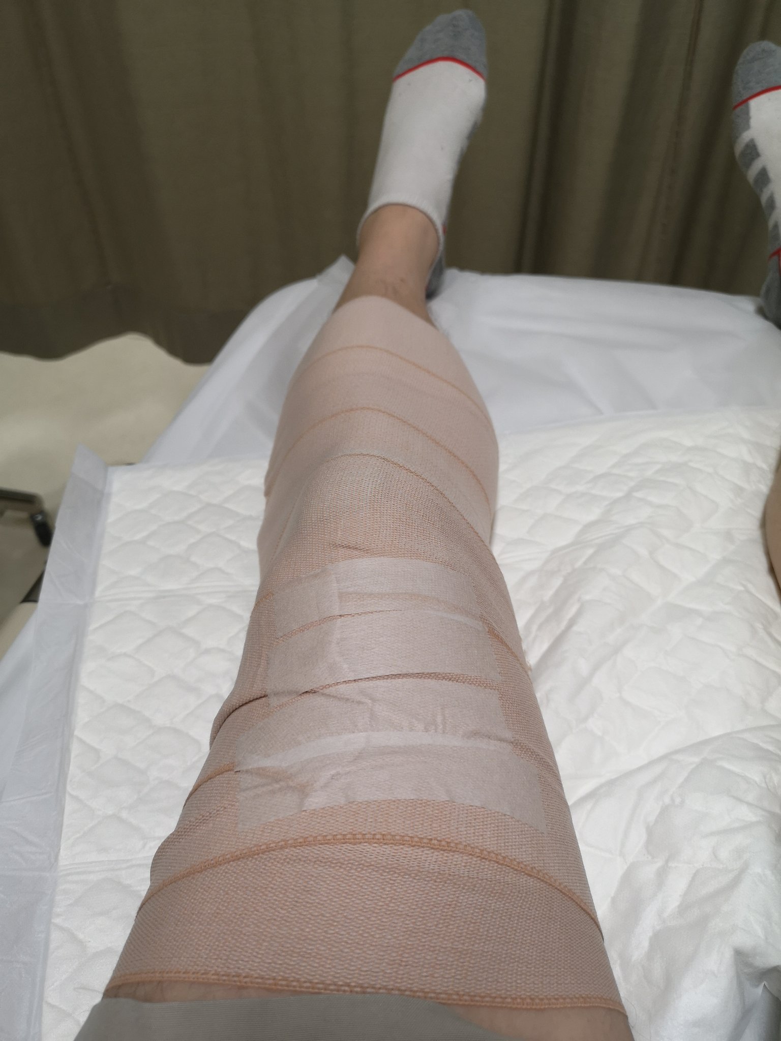 Broken Knee Cast