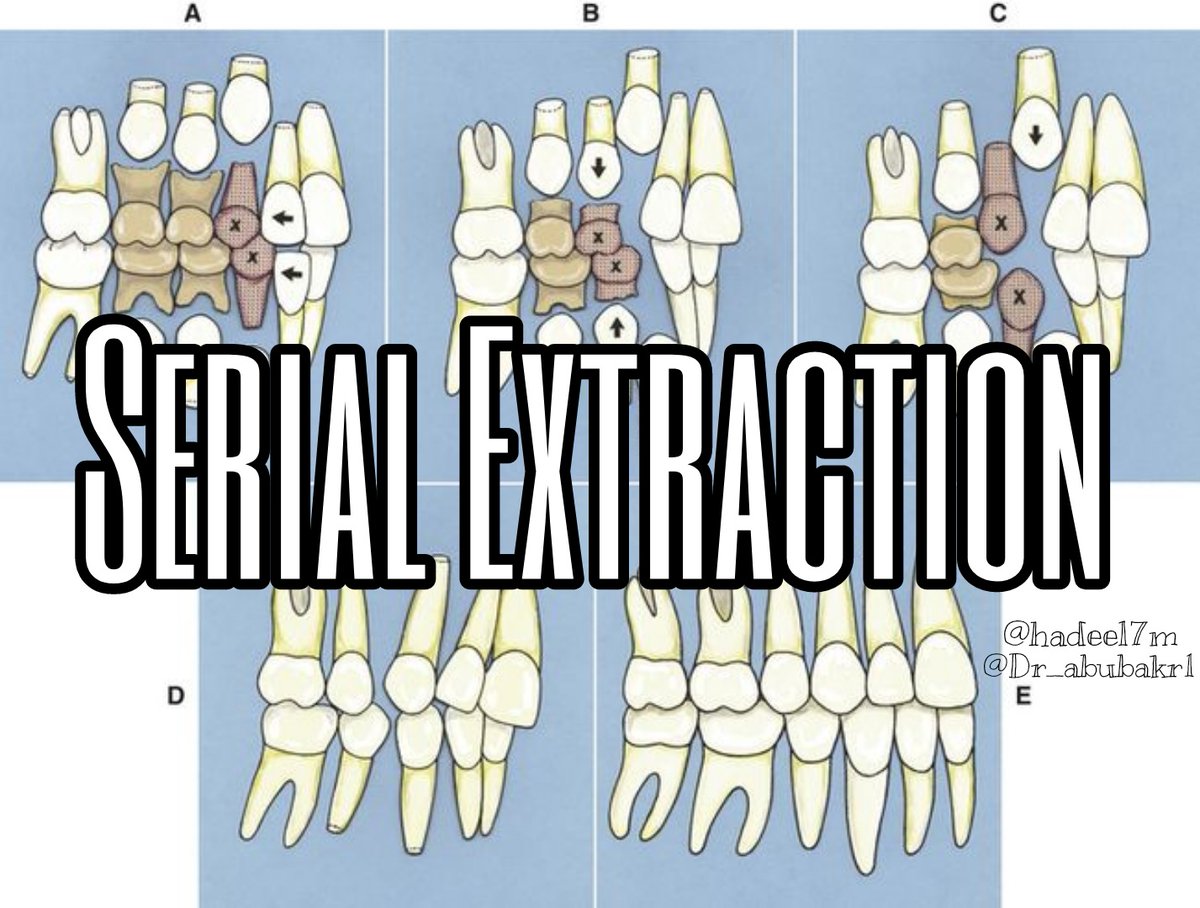 Serial extraction #Dental_by_Hadeel - المسلسل من هديل 🕊 @Hadeel7m - رتبها