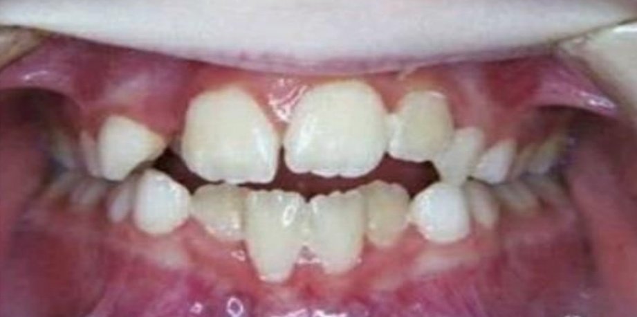 Serial extraction #Dental_by_Hadeel - المسلسل من هديل 🕊 @Hadeel7m - رتبها