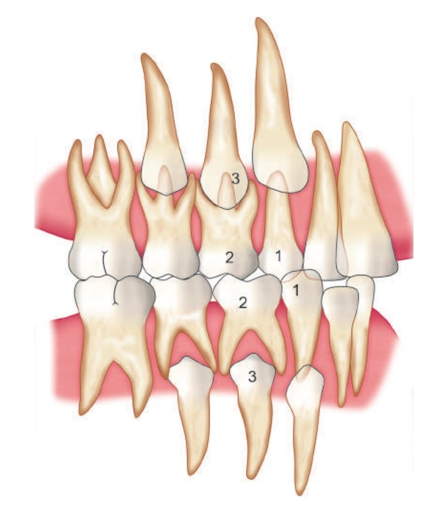 Serial extraction #Dental_by_Hadeel - Thread from هديل 🕊 @Hadeel7m ...