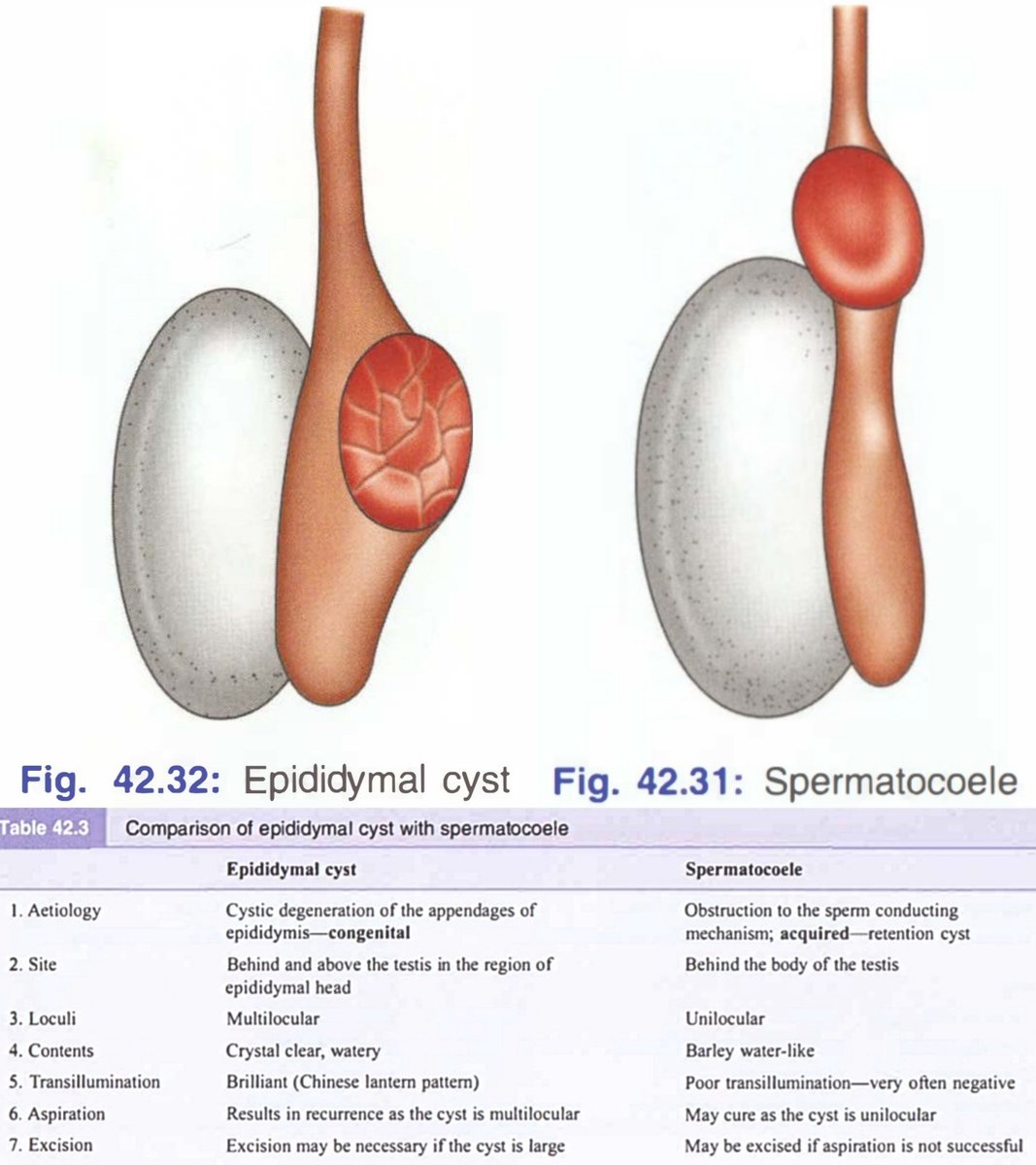 Epididymal Cyst