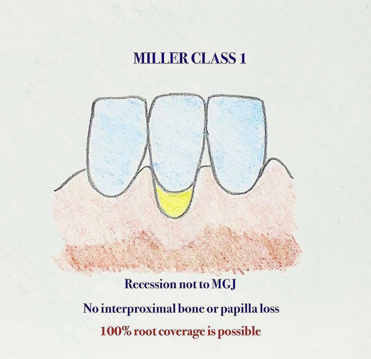 Gingival Recession Classification