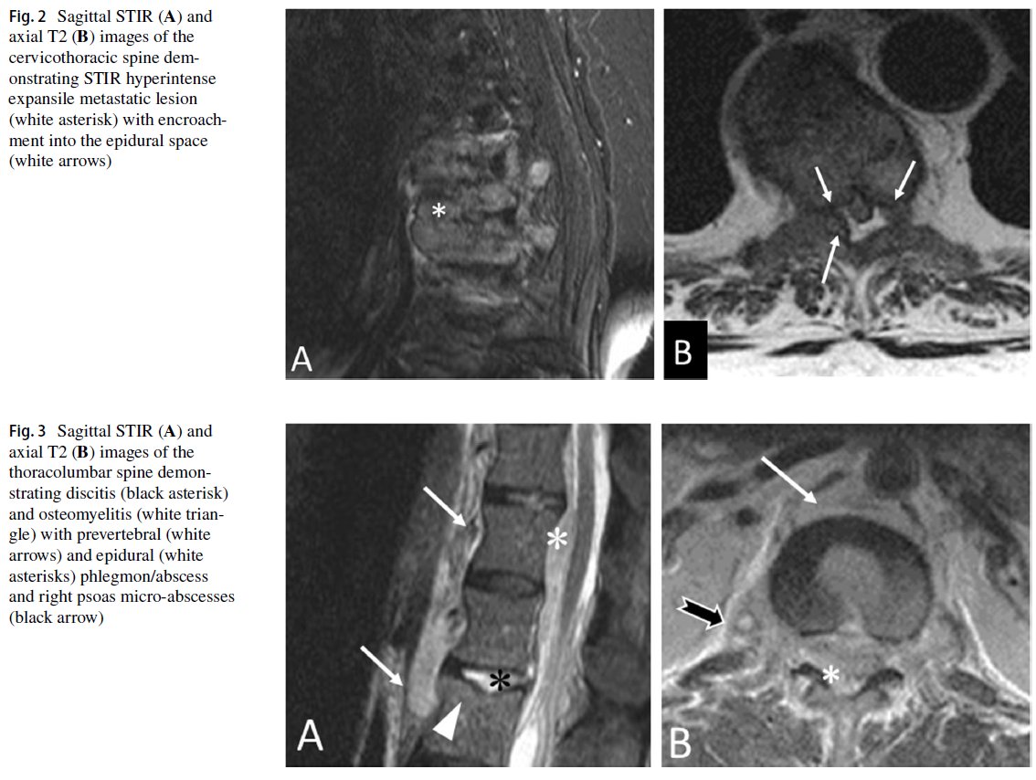Lumbar Spine Mri Axial
