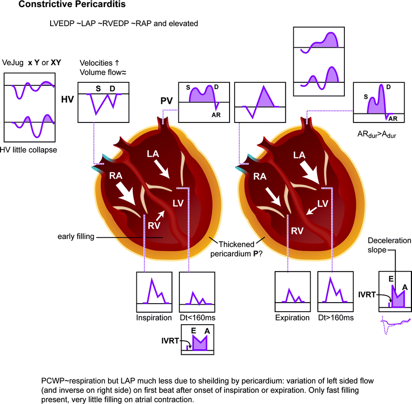 Constrictive Pericarditis Hemodynamics