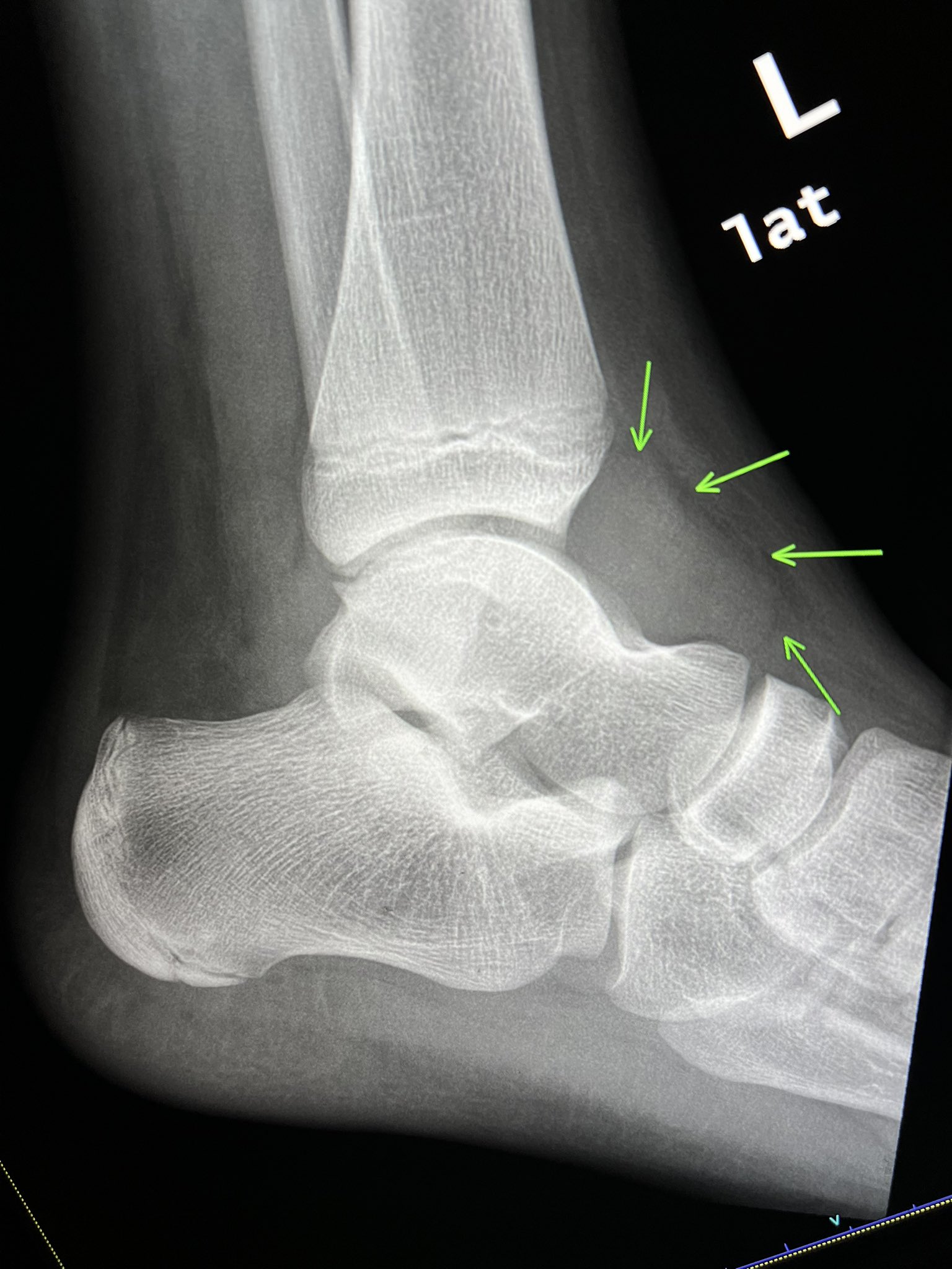 Ankle Effusion X Ray